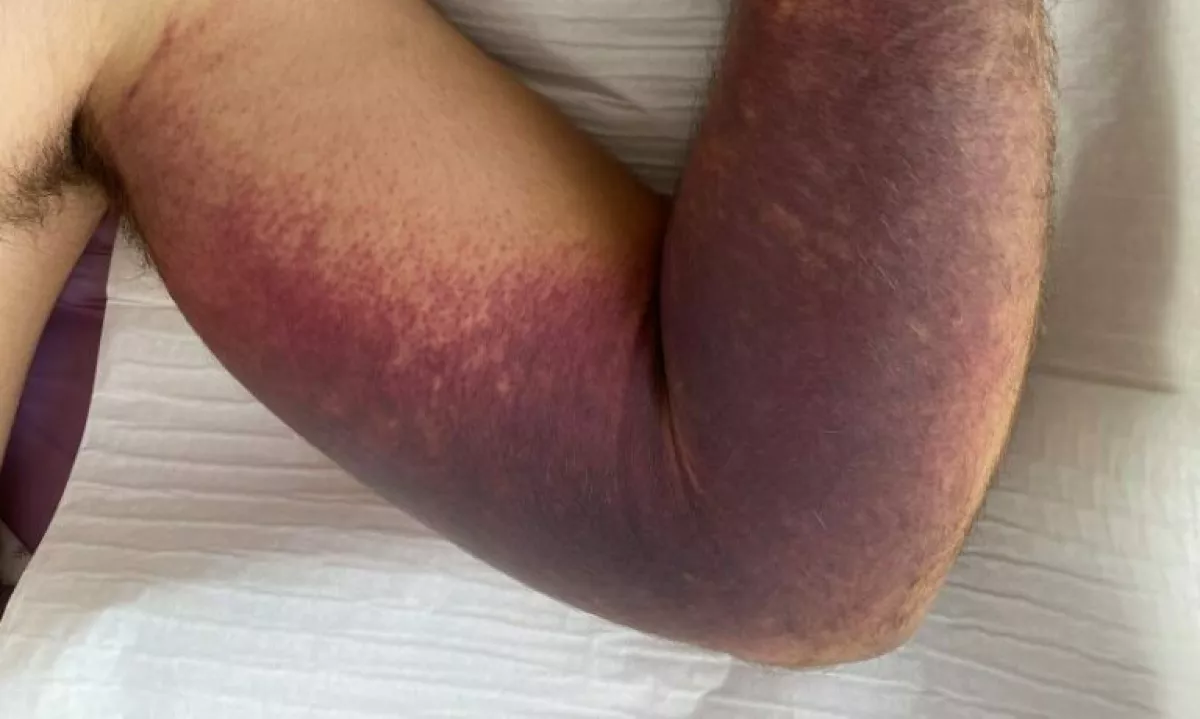 Modras ugriznil plezalca v Iškem vintgarju