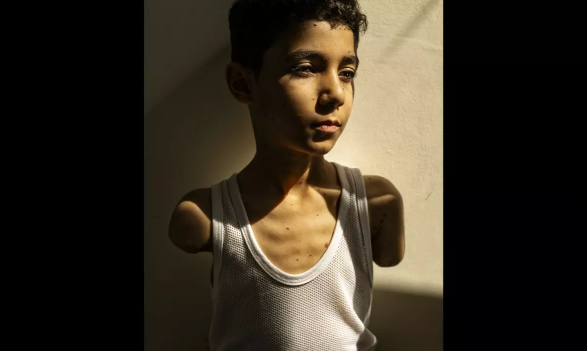 Fotografija leta: Amputirani devetletni deček kot simbol brutalne vojne